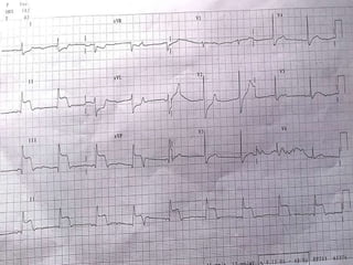 ECG: Myocardial Infarction with CHB | PPT