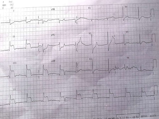 ECG: Myocardial Infarction with CHB | PPT