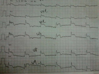 ECG: Myocardial Infarction with CHB | PPT