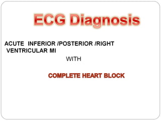 ECG: Myocardial Infarction with CHB | PPT