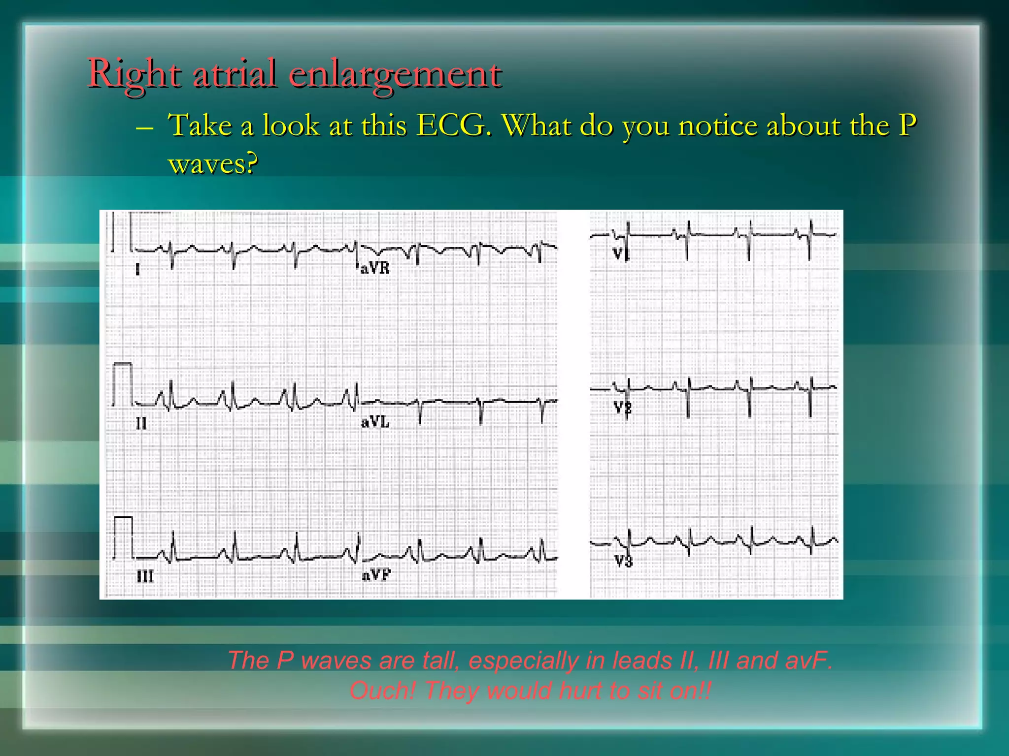 ECG BY Dr.MOHAMED RAMADAN | PPT