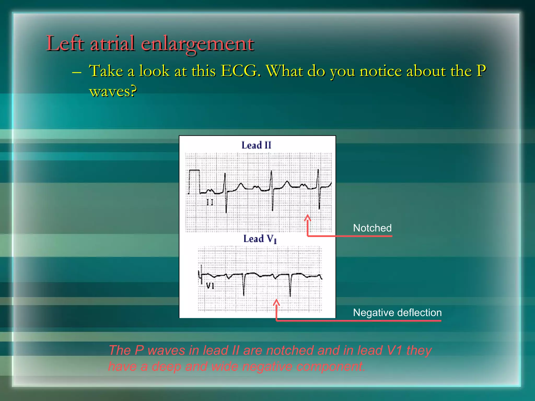 ECG BY Dr.MOHAMED RAMADAN | PPT