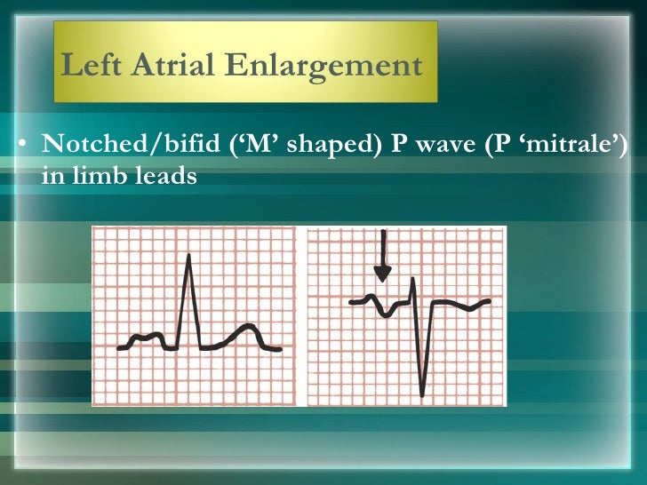 ECG BY Dr.MOHAMED RAMADAN