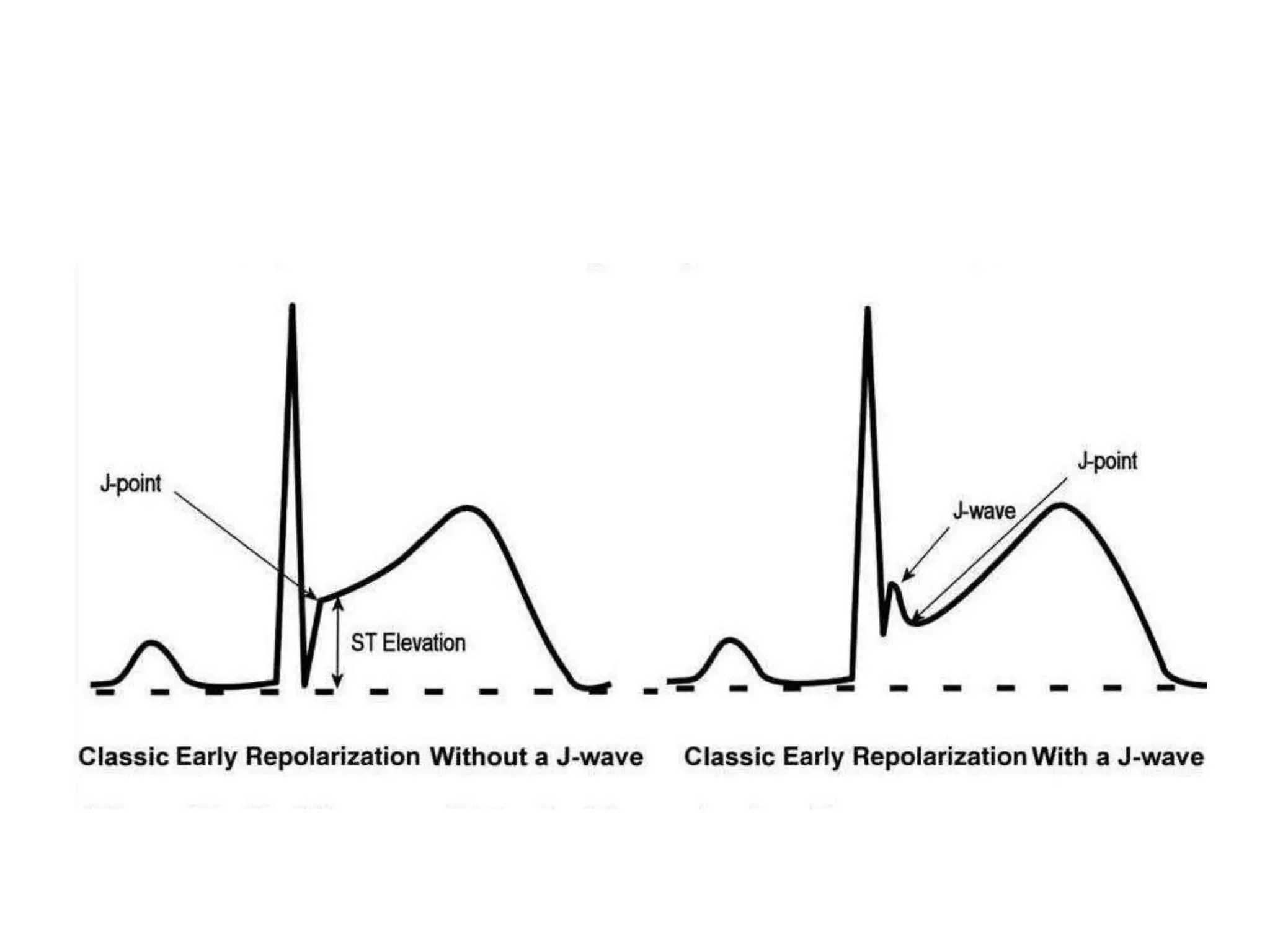ECG MONITORING AND ECG CHANGES OF INTRAOPERATIVE MYOCARDIAL.pptx
