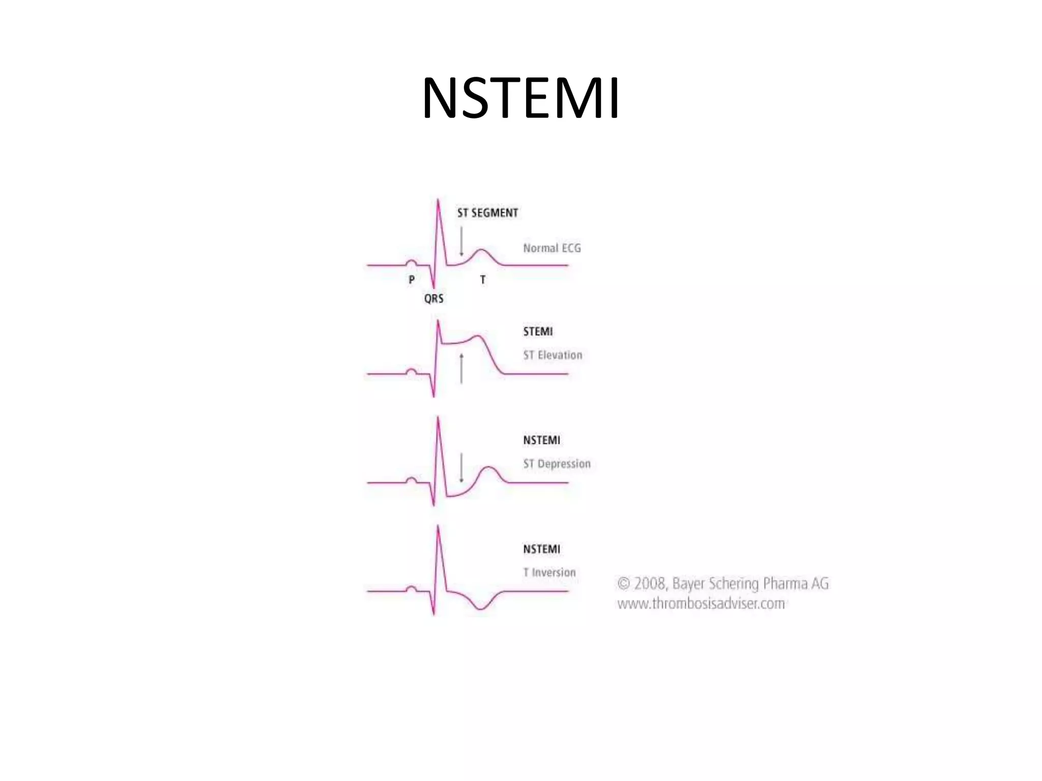 ECG MONITORING AND ECG CHANGES OF INTRAOPERATIVE MYOCARDIAL.pptx