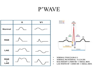 ECG MONITORING AND ECG CHANGES OF INTRAOPERATIVE MYOCARDIAL.pptx
