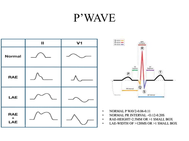 ECG MONITORING AND ECG CHANGES OF INTRAOPERATIVE MYOCARDIAL.pptx ...