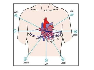 ECG MONITORING AND ECG CHANGES OF INTRAOPERATIVE MYOCARDIAL.pptx