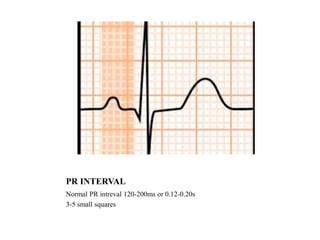 ECG MONITORING AND ECG CHANGES OF INTRAOPERATIVE MYOCARDIAL.pptx