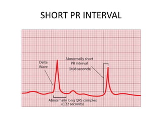 ECG MONITORING AND ECG CHANGES OF INTRAOPERATIVE MYOCARDIAL.pptx