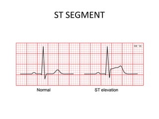 ECG MONITORING AND ECG CHANGES OF INTRAOPERATIVE MYOCARDIAL.pptx