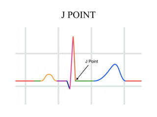 ECG MONITORING AND ECG CHANGES OF INTRAOPERATIVE MYOCARDIAL.pptx