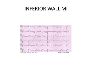ECG MONITORING AND ECG CHANGES OF INTRAOPERATIVE MYOCARDIAL.pptx