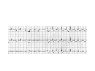 ECG MONITORING AND ECG CHANGES OF INTRAOPERATIVE MYOCARDIAL.pptx