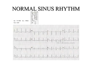 ECG MONITORING AND ECG CHANGES OF INTRAOPERATIVE MYOCARDIAL.pptx