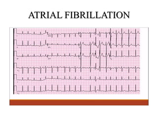 ECG MONITORING AND ECG CHANGES OF INTRAOPERATIVE MYOCARDIAL.pptx