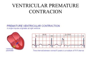 ECG MONITORING AND ECG CHANGES OF INTRAOPERATIVE MYOCARDIAL.pptx