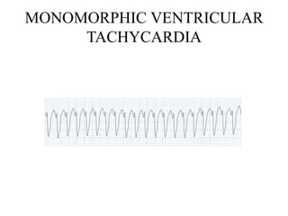 ECG MONITORING AND ECG CHANGES OF INTRAOPERATIVE MYOCARDIAL.pptx