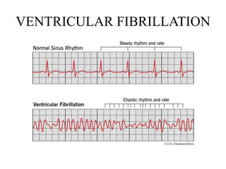 ECG MONITORING AND ECG CHANGES OF INTRAOPERATIVE MYOCARDIAL.pptx