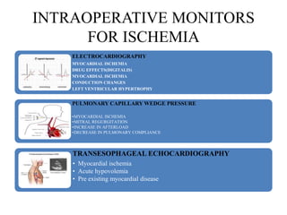 ECG MONITORING AND ECG CHANGES OF INTRAOPERATIVE MYOCARDIAL.pptx