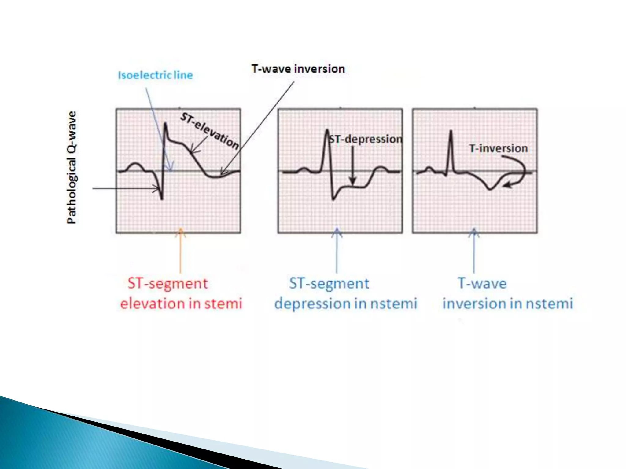 ECG Changes in Myocardial Infarction | PPTX