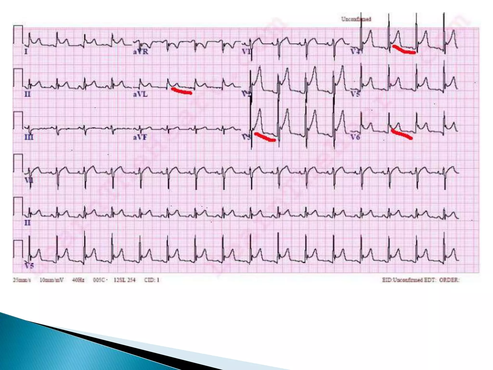 ECG Changes in Myocardial Infarction | PPTX