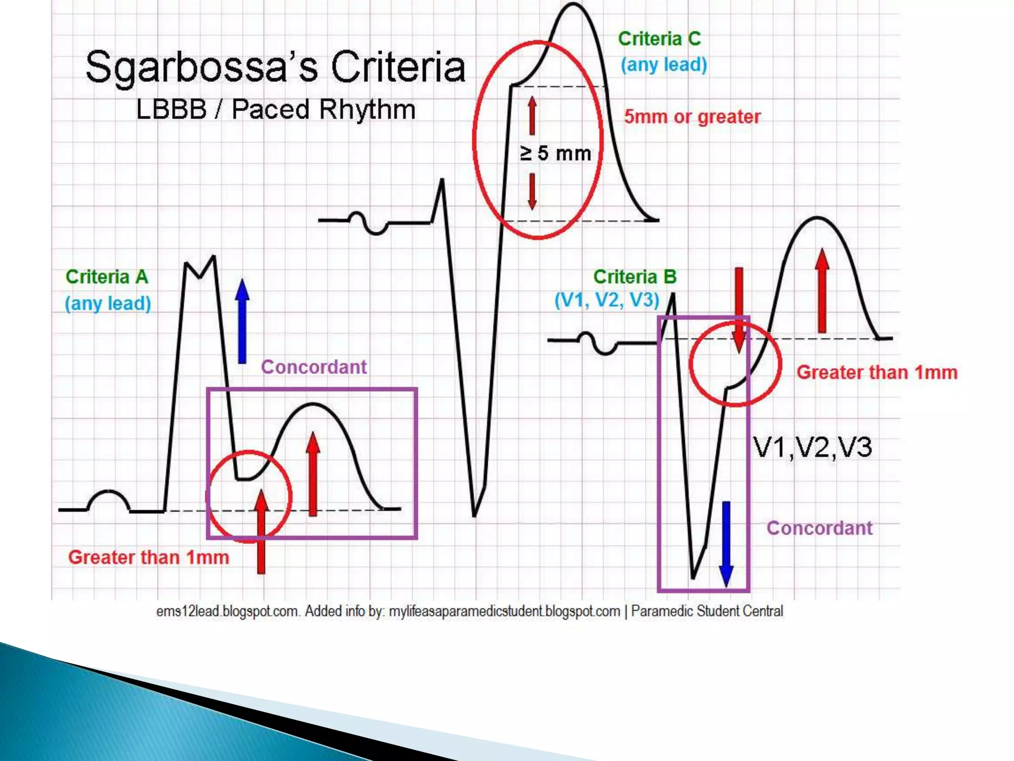 ECG Changes in Myocardial Infarction | PPTX