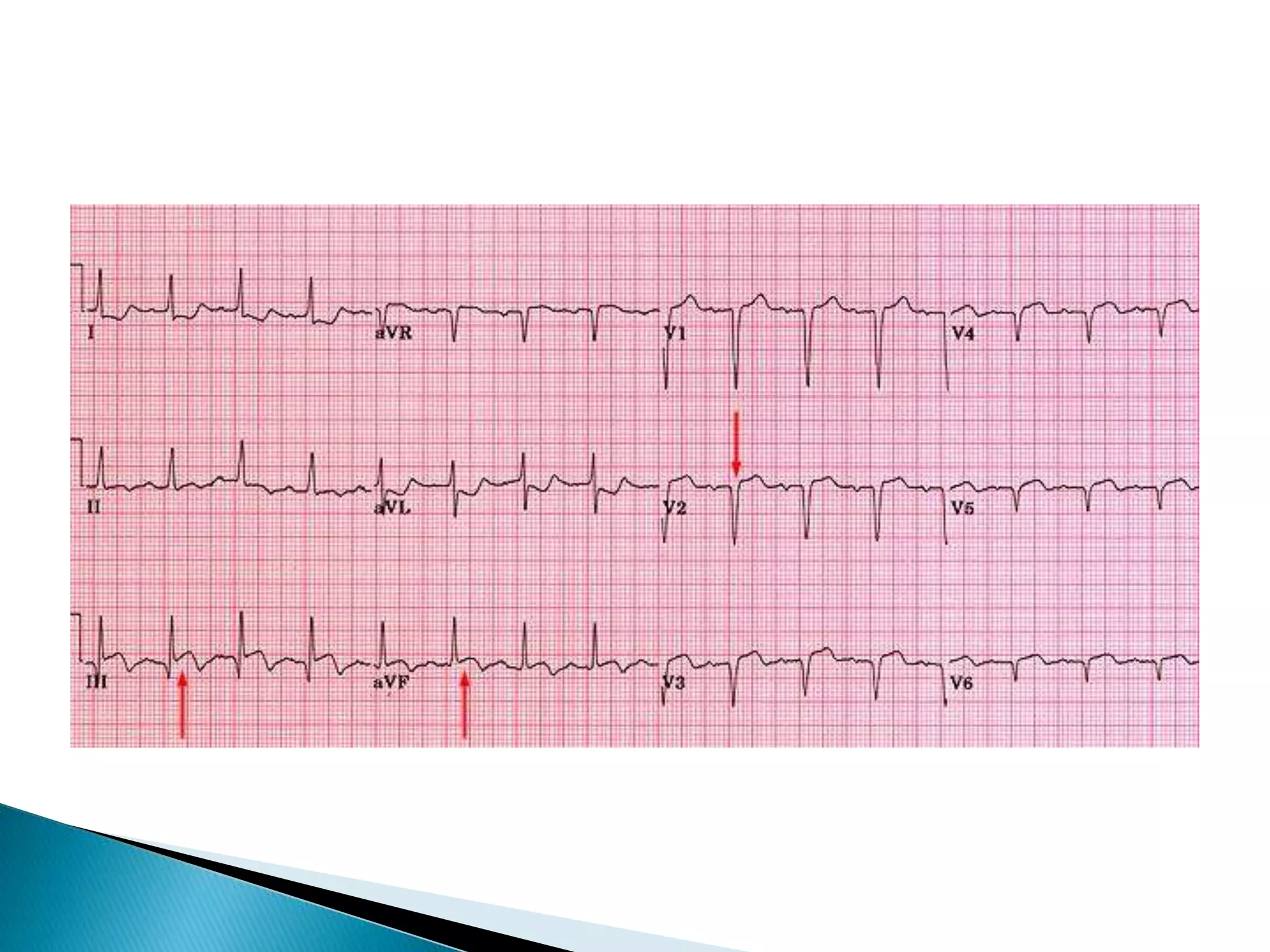 ECG Changes in Myocardial Infarction | PPTX