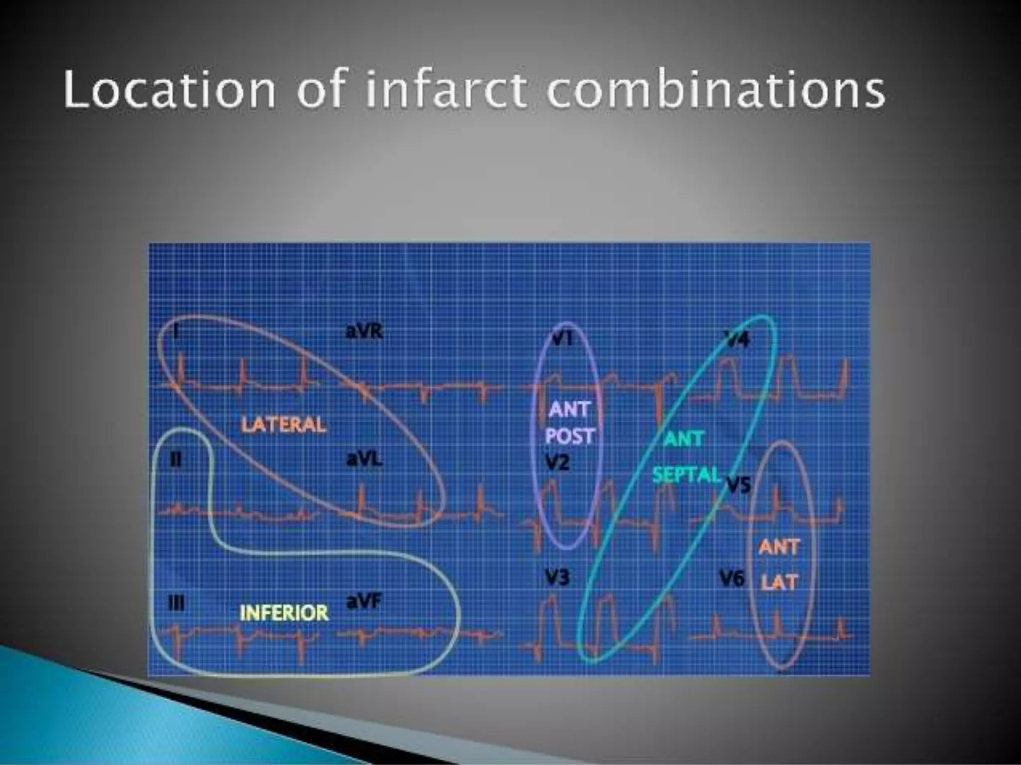 ECG Changes in Myocardial Infarction | PPTX