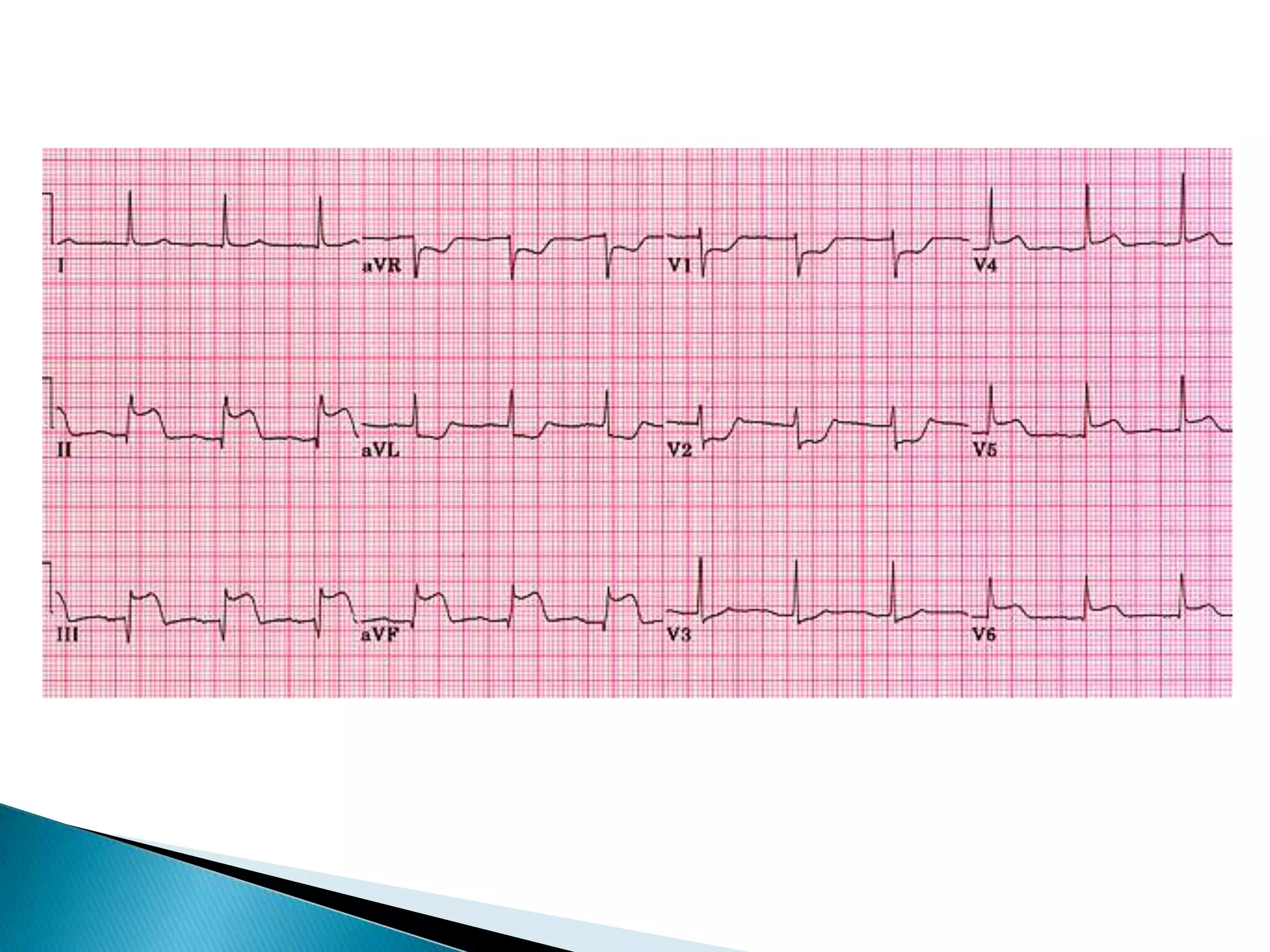 ECG Changes in Myocardial Infarction | PPTX