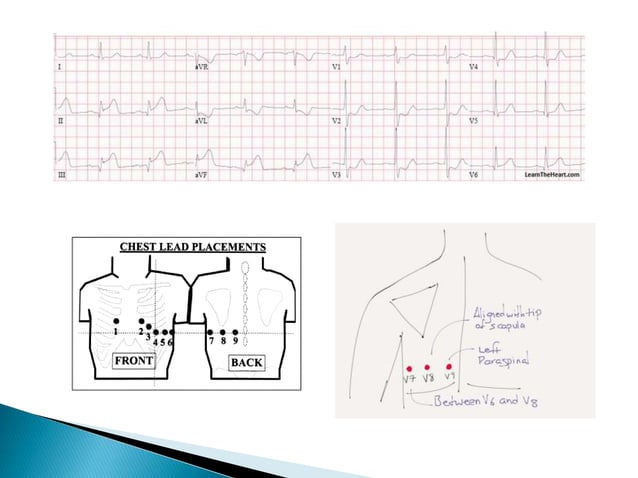ECG Changes in Myocardial Infarction | PPTX | Heart and Cardiovascular ...