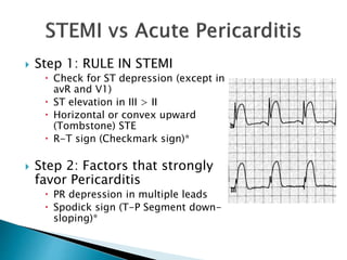 ECG Changes in Myocardial Infarction | PPTX