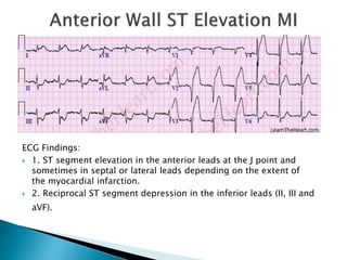 ECG Changes in Myocardial Infarction | PPTX