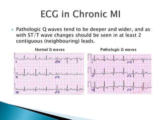 Mi Ekg
