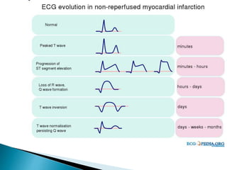 Myocardial Infarction Ecg Interpretation
