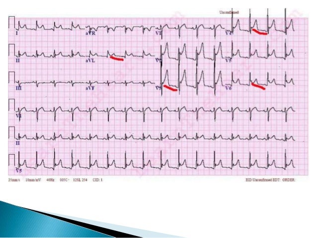 ECG Changes in Myocardial Infarction