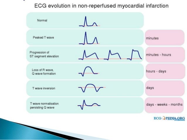 ECG Changes in Myocardial Infarction