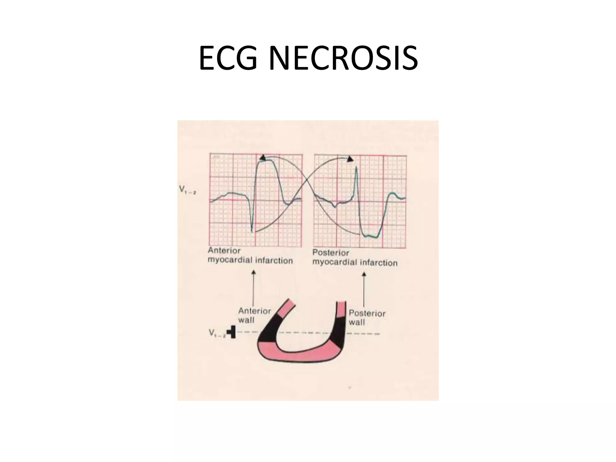 Ecg necrosis | PPT