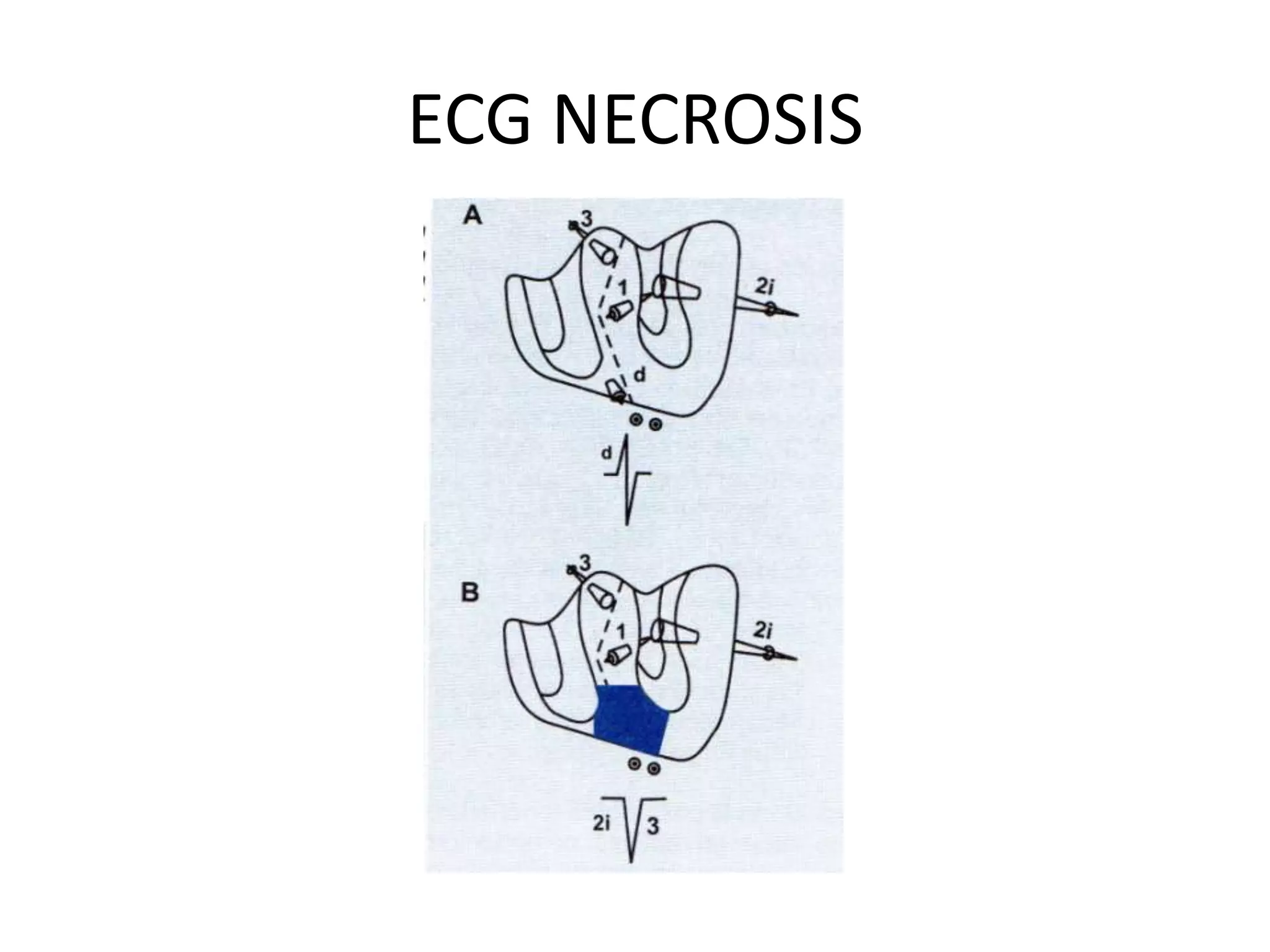 Ecg necrosis | PPT