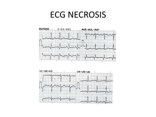Ecg necrosis | PPT