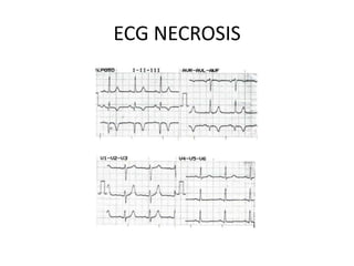 Ecg necrosis | PPT