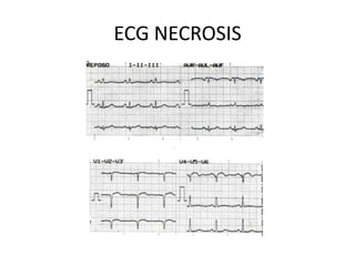 Ecg necrosis | PPT
