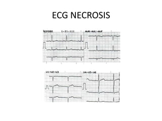 Ecg necrosis | PPTX