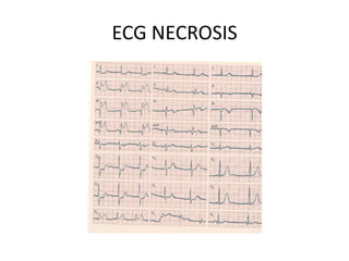 Ecg necrosis | PPT