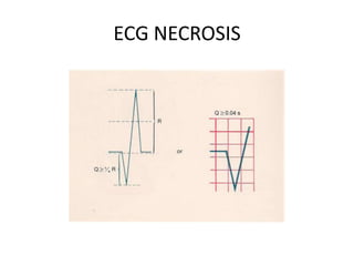 Ecg necrosis | PPT