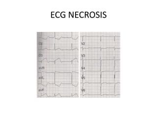 Ecg necrosis | PPT