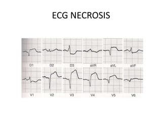 Ecg necrosis | PPT