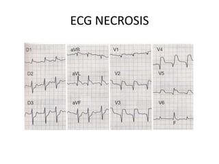 Ecg necrosis | PPT