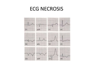Ecg necrosis | PPT