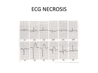 Ecg necrosis | PPTX